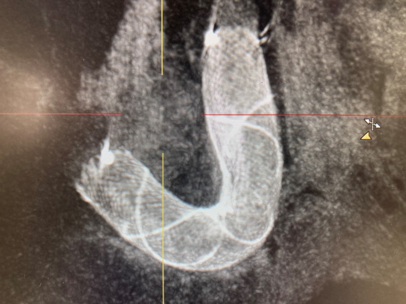Primer caso de tratamiento de aneurisma cerebral con stent diversor de ...